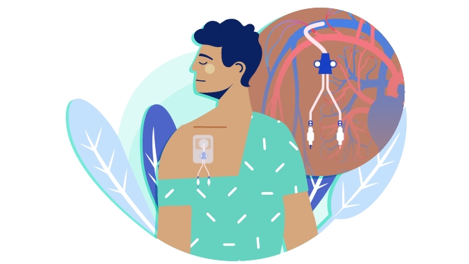 Reservorios subcutáneos: catéter Hickman, PICC y otras vías centrales