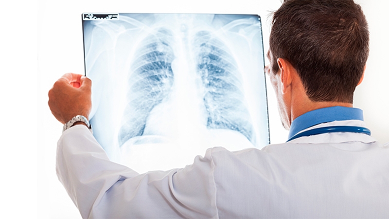 ¿Qué es un Nódulo Pulmonar?