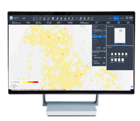 HER2 (4B5) breast cancer algorithm by navify® Digital Pathology