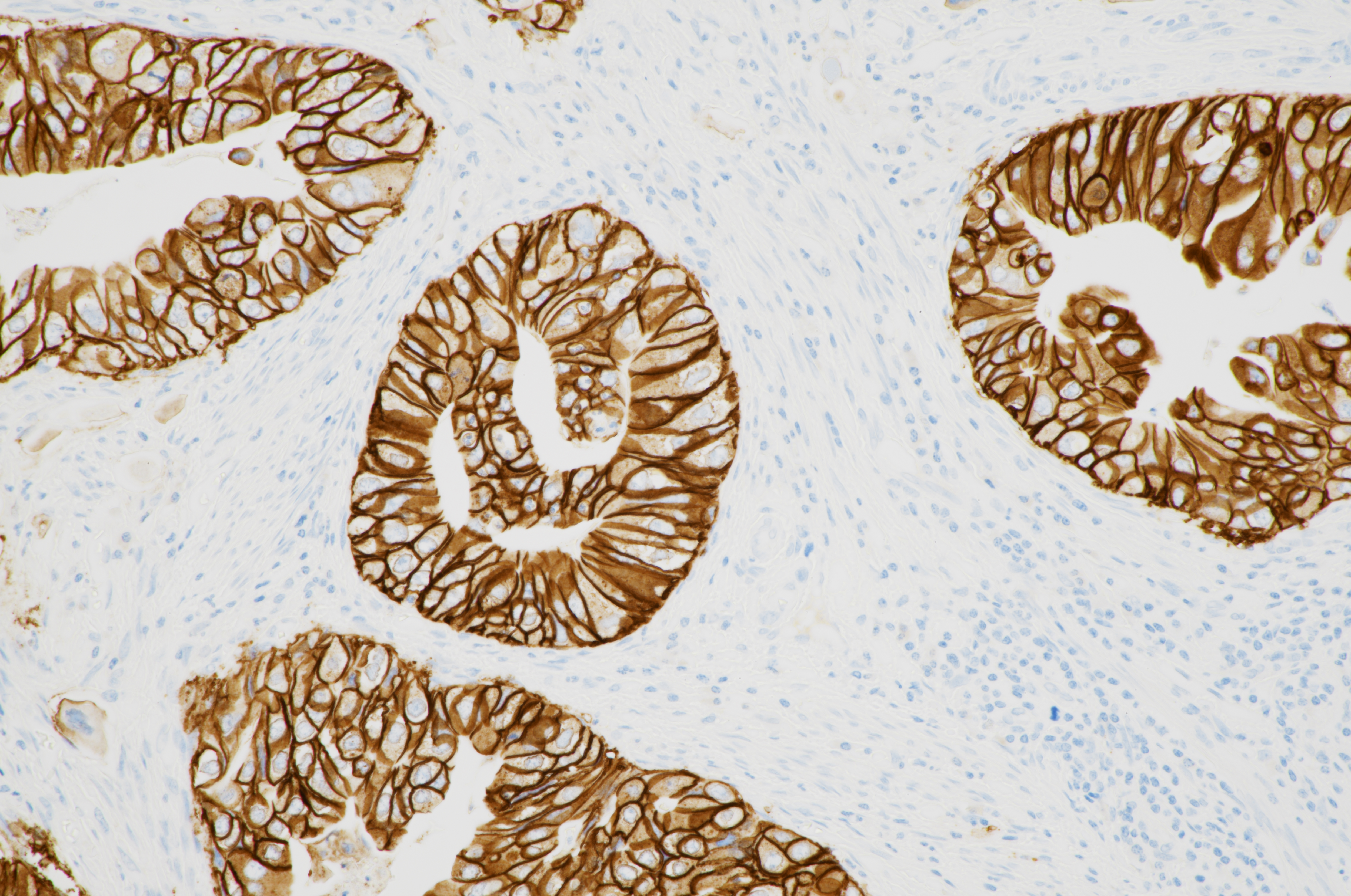 Roche receives FDA approval for first companion diagnostic to identify ...
