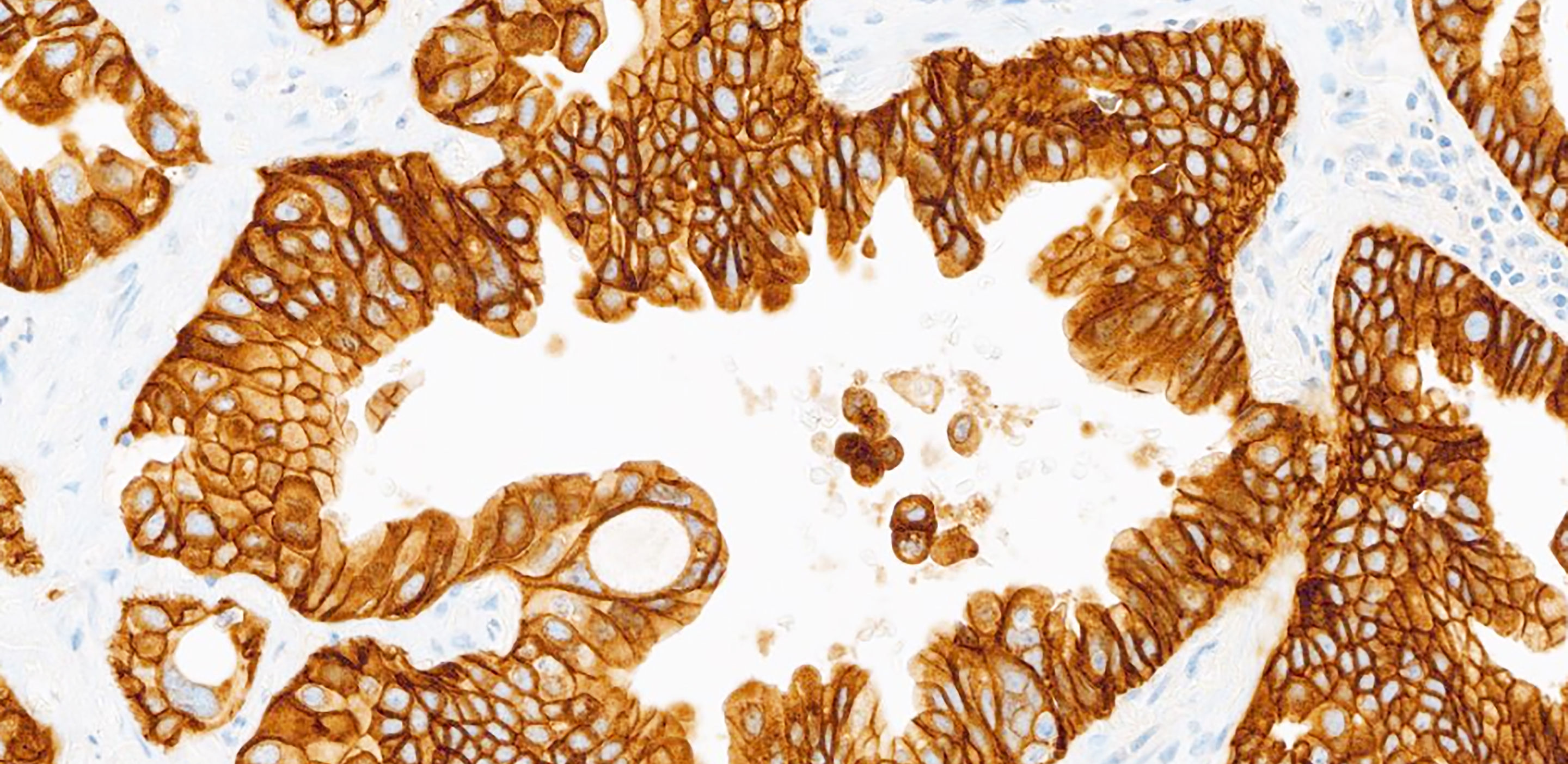 Roche receives FDA approval for the VENTANA MET (SP44) RxDx Assay as ...