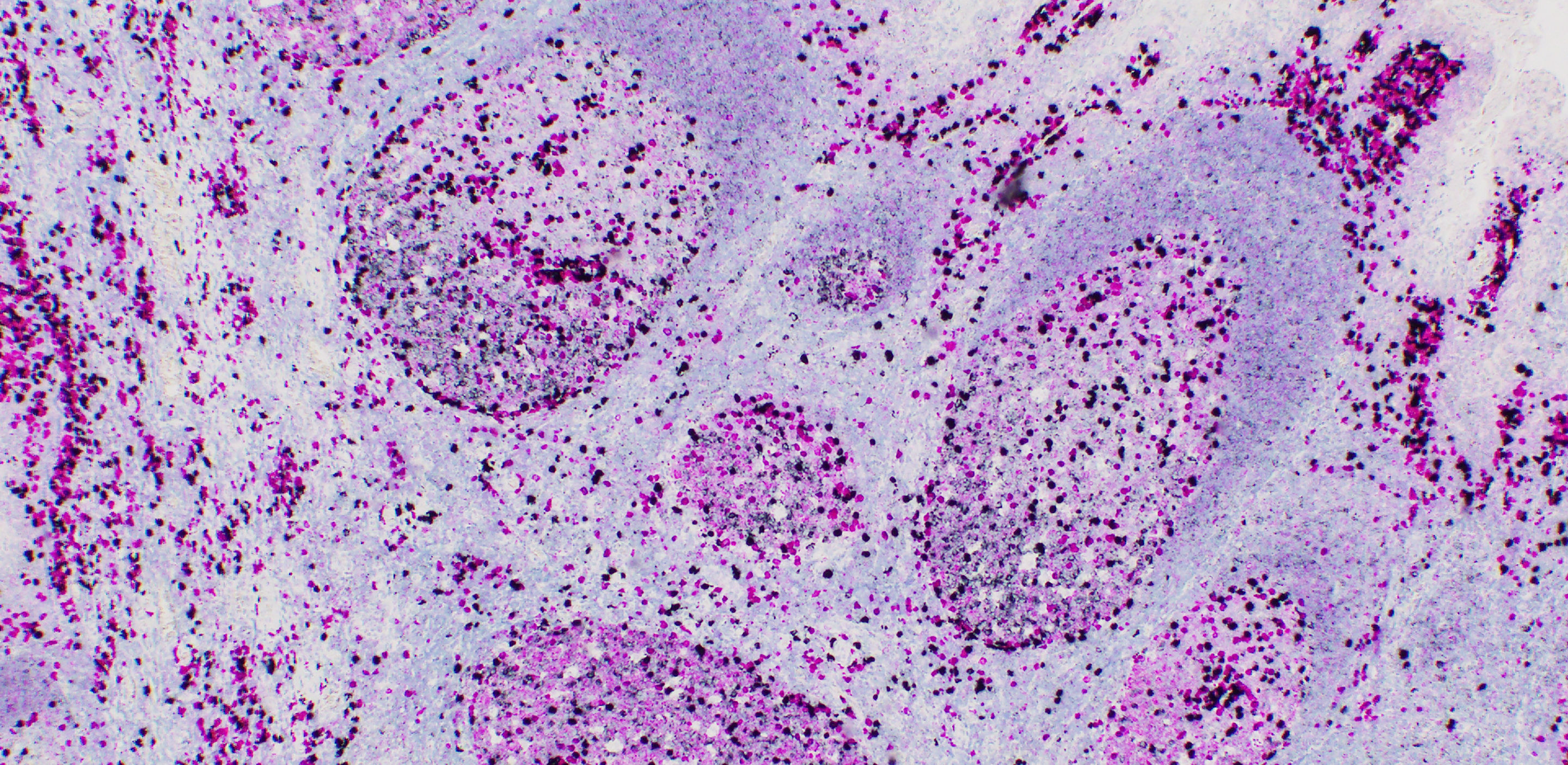 Roche receives FDA clearance for new, highly sensitive test to aid ...