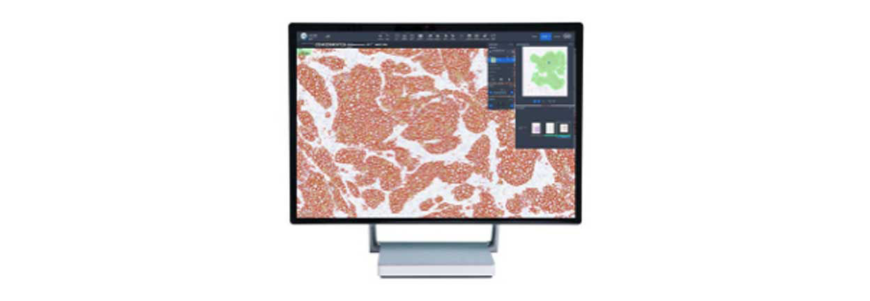 HER2 (4B5), breast cancer algorithm by navify® Digital Pathology